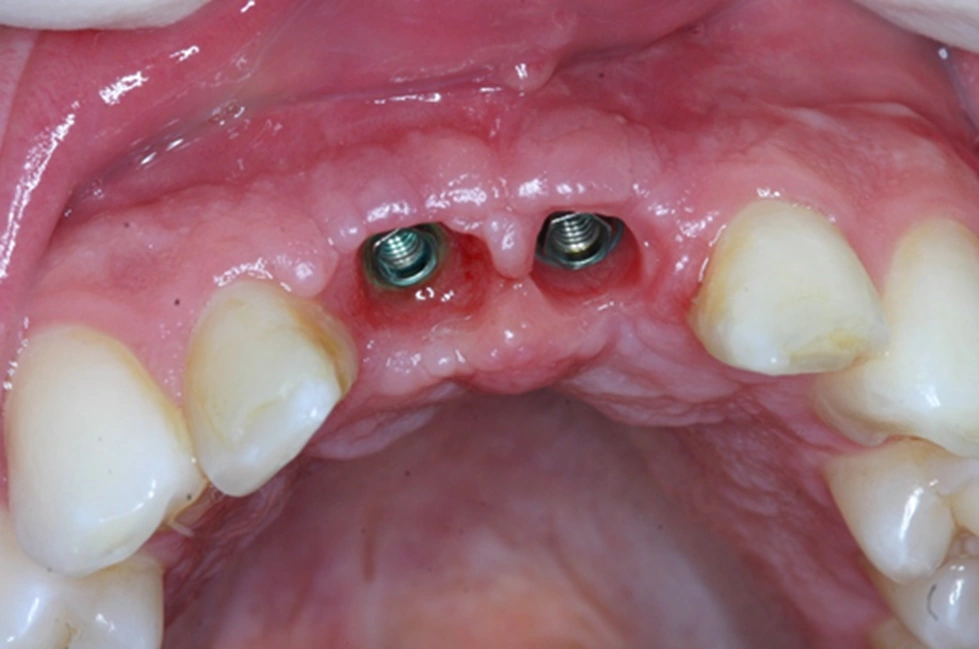 Placement of a Well-contoured Provisional Restoration/Custom Healing ...