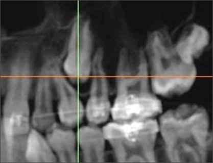 Transposition - Anomalies of Tooth Structure - Dentalcare