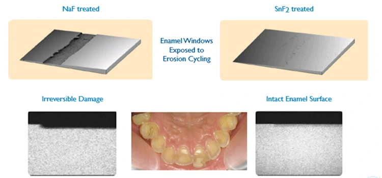 Dental Erosion | A-Z Fundamentals of Dentifrice | Continuing Education ...