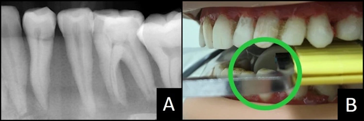 Horizontal Angulation: How do I know that the distal canine crown will ...