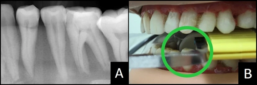 Horizontal Angulation: How do I know that the distal canine crown will ...