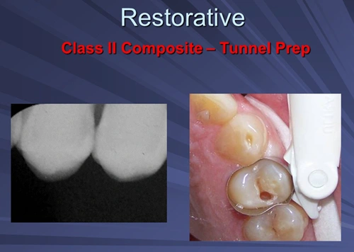 Restorative Dentistry | Lasers in Dentistry: Minimally Invasive ...