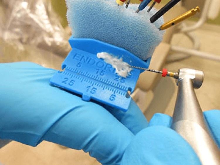 Conventional Endodontic Treatment - A Clinician’s Guide to Clinical ...