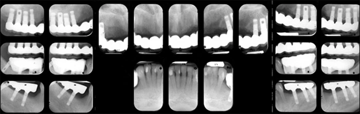 Full Mouth Surveys - Intraoral Radiographic Anatomy - Dentalcare
