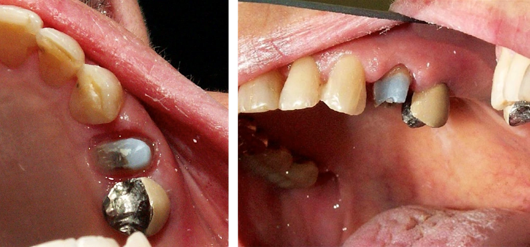 Minimal Flap Crown Lengthening | Lasers in Dentistry: Minimally ...