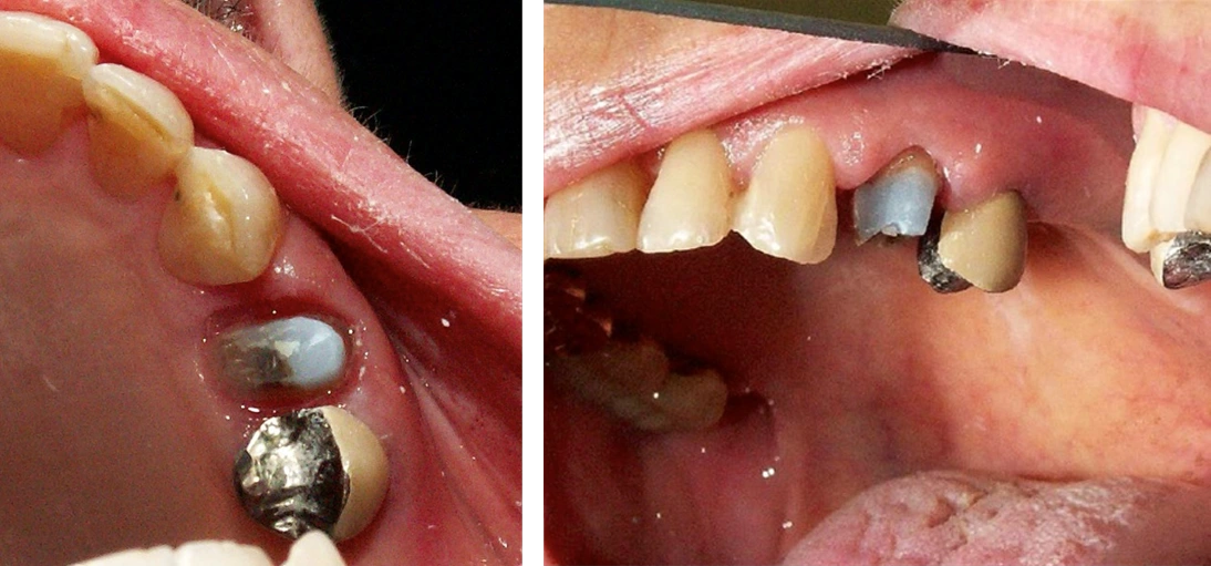 Minimal Flap Crown Lengthening | Lasers in Dentistry: Minimally ...