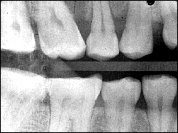 Technique Errors - Intraoral Imaging: Basic Principles, Techniques and ...
