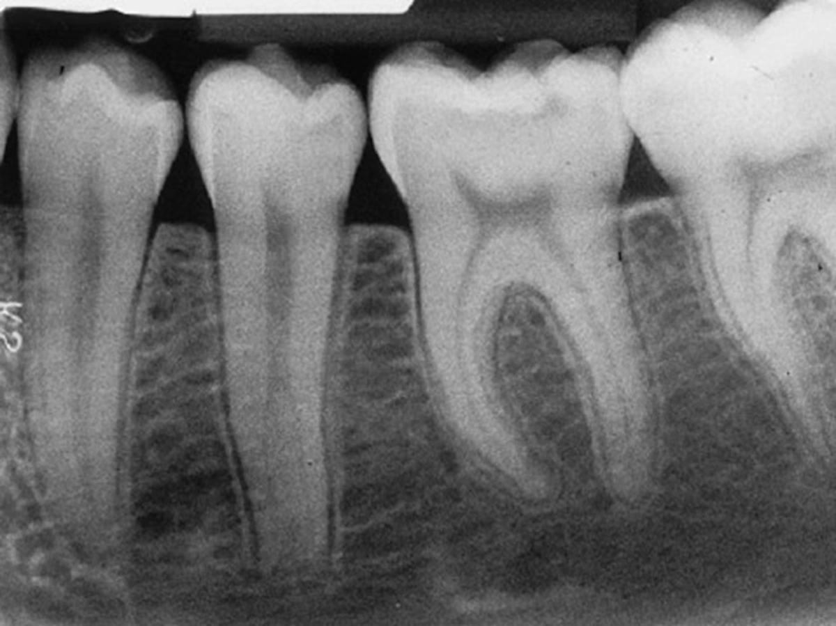 Accessory Cusps - Anomalies of Tooth Structure - Dentalcare