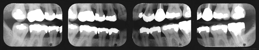 Adult Dentate Patient - Radiographic Selection Criteria - Dentalcare