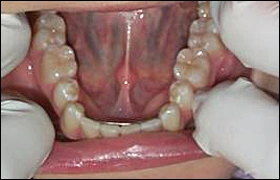 Floor of the Mouth - The Intraoral and Extraoral Exam - Dentalcare