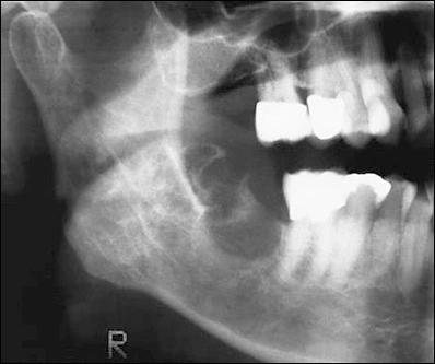 Diagnostic Information | An Expansile Mass of the Right Posterior ...