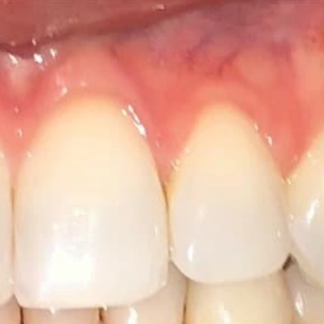 Anatomy & Histology of the Gingival Unit and Basic Oral Hygiene ...