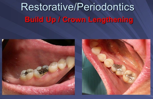 Crown Lengthening with Minimally Invasive Flap Design | Lasers in ...