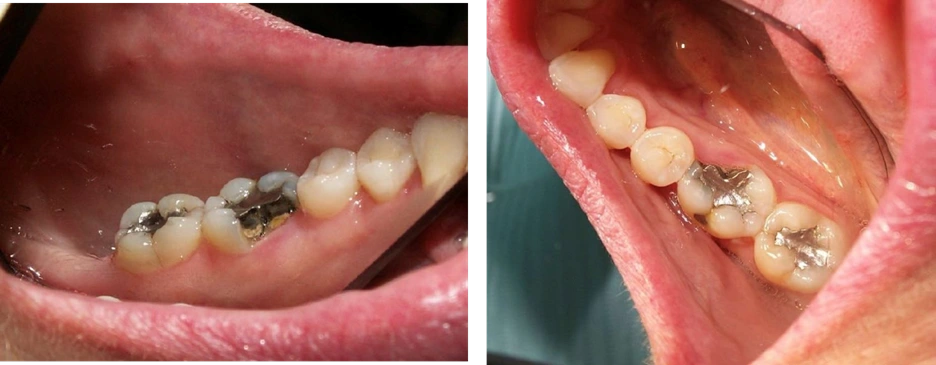 Crown Lengthening with Minimally Invasive Flap Design | Lasers in ...