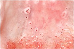 Nicotinic Stomatitis