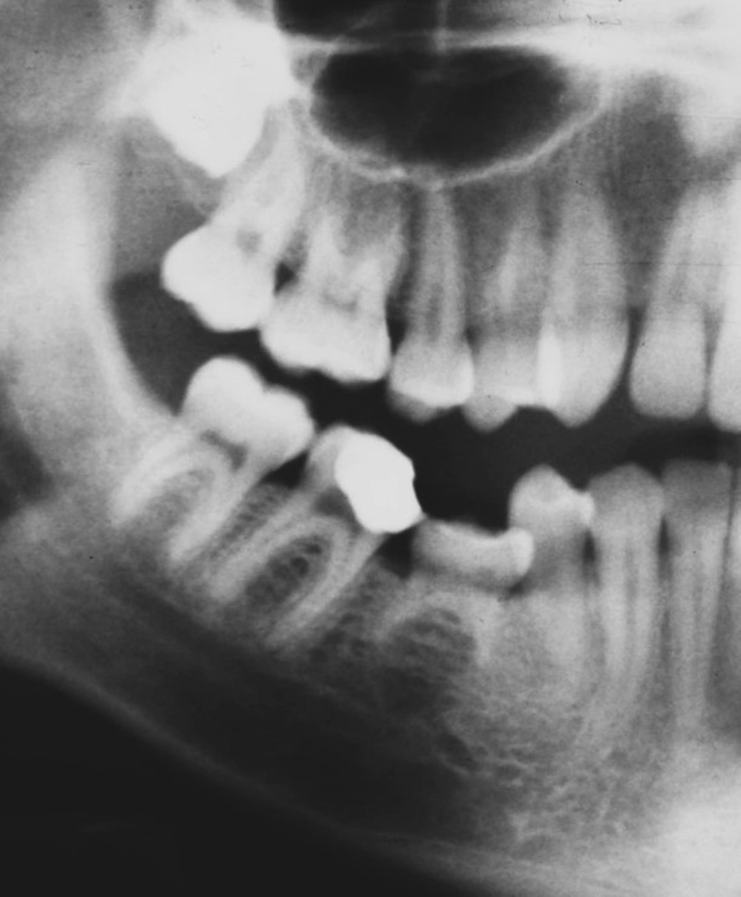 Delayed Eruption - Anomalies of Tooth Structure - Dentalcare