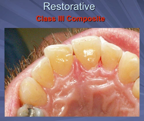 Restorative Dentistry | Lasers in Dentistry: Minimally Invasive ...