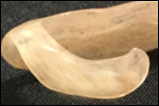 Clasp Designs | Non-Metal Clasp Dentures | Continuing Education Course ...