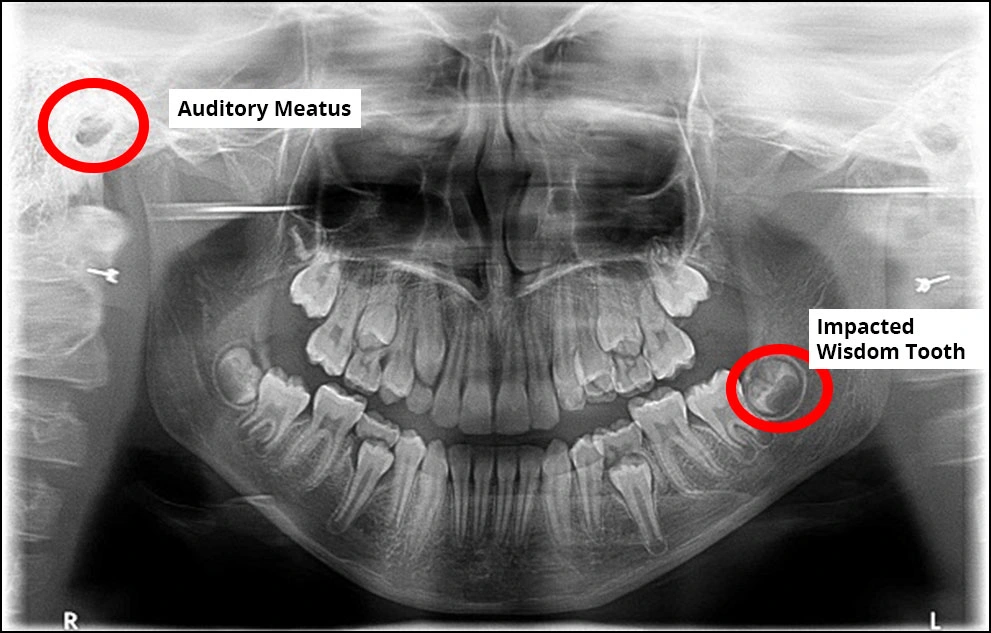 Use of Panoramic Imaging for Patient Education - Panoramic Radiographs ...