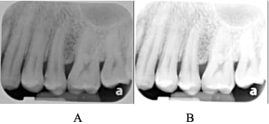 Radiographic Density - The Radiographic Image - Dentalcare