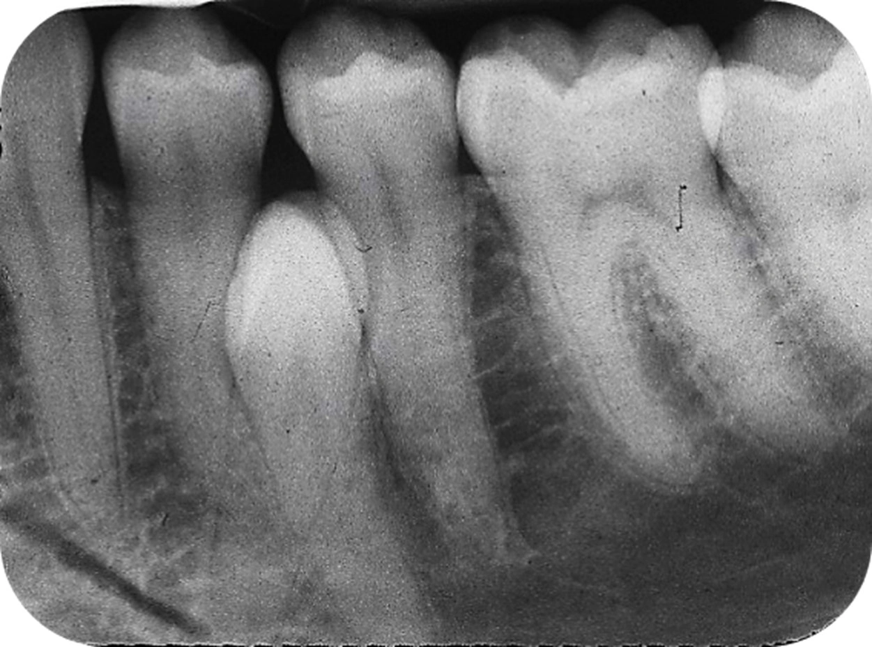 Accessory Cusps - Anomalies of Tooth Structure - Dentalcare