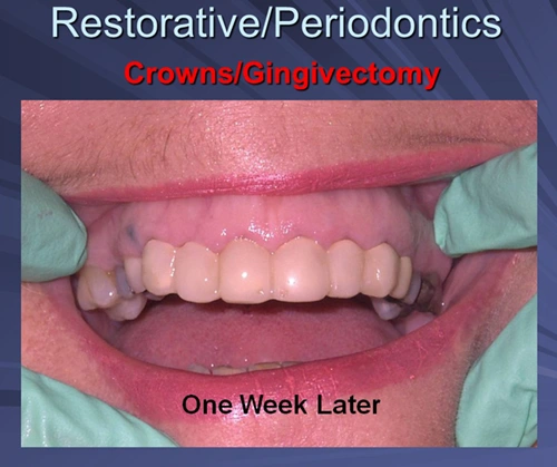 Gingivectomy | Lasers in Dentistry: Minimally Invasive Instruments for ...