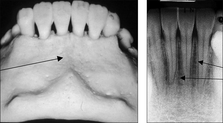 Mandibular Anterior Landmarks - Intraoral Radiographic Anatomy - Dentalcare