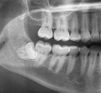 Delayed Eruption - Anomalies of Tooth Structure - Dentalcare