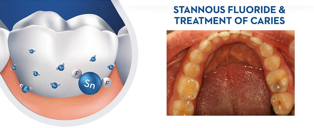 Dental Caries Treatment - Stannous Fluoride Toothpaste | Dentalcare