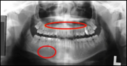 Features of an Optimal Panoramic Radiograph - Practical Panoramic ...