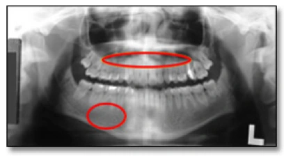 Features of an Optimal Panoramic Radiograph - Practical Panoramic ...