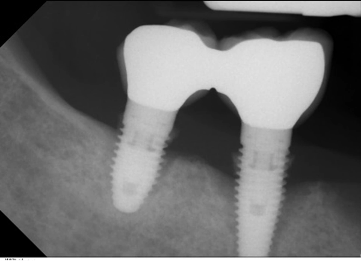 Definitions | Peri-implantitis: All You Want (or not) to Know ...