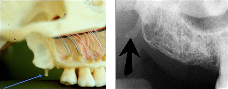 Maxillary Posterior Landmarks - Intraoral Radiographic Anatomy - Dentalcare