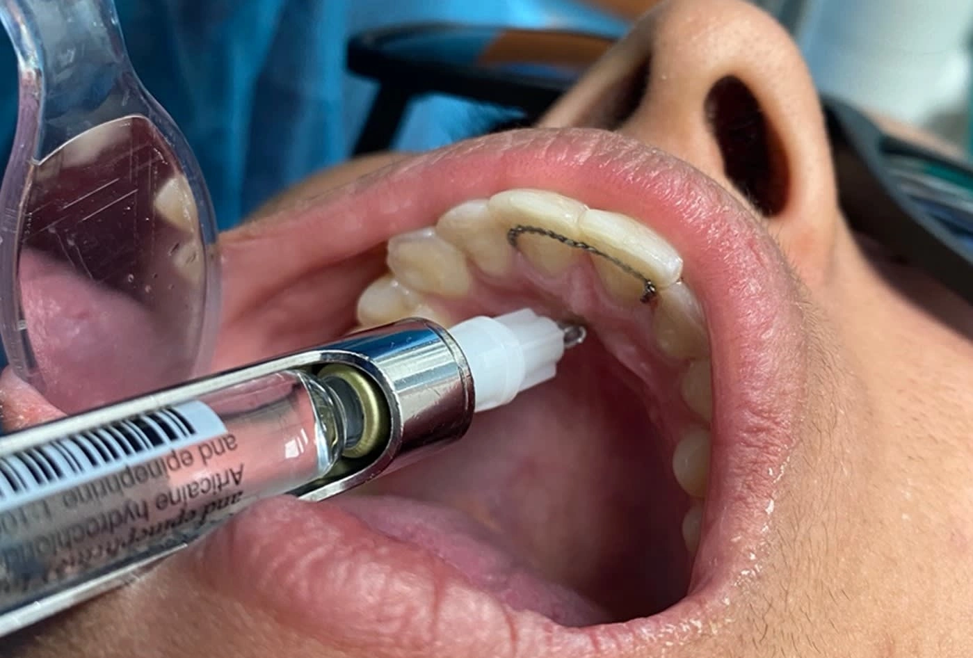 Nasopalatine Nerve Block - Local Anesthesia in Pediatric Dentistry ...