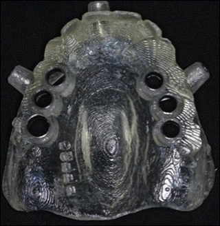 Diagnosis and Treatment Planning for Implant Prostheses - Full Arch ...