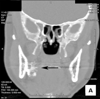 Diagnostic Information | An Expansile Mass of the Right Posterior ...