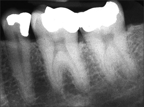 Taurodontism - Anomalies of Tooth Structure - Dentalcare