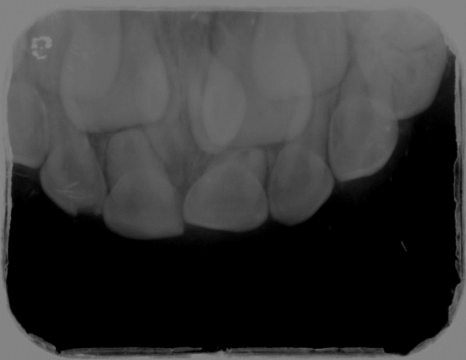Case #2 Diagnoses: Developing Mesiodens - Radiographic Interpretations ...