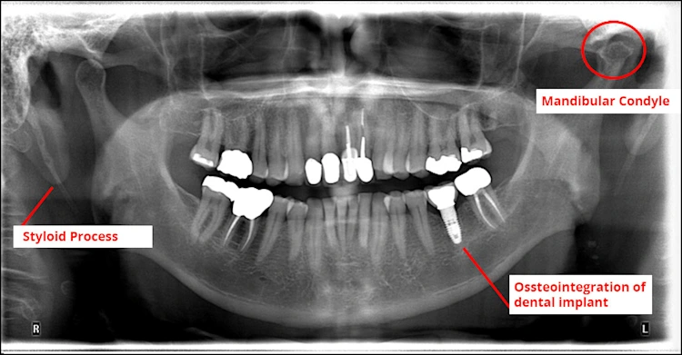 Review of Normal Anatomical Landmarks and Variations - Panoramic ...