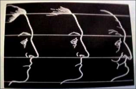 Clinical Signs of Bruxism - Bruxism: The Grind of the Matter - Dentalcare