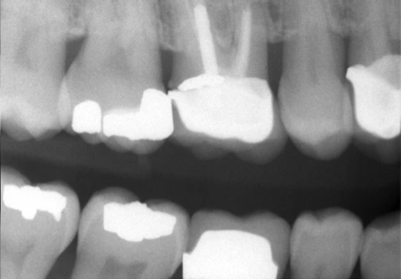 Technique Errors - Intraoral Imaging: Basic Principles, Techniques and Error Correction - Dentalcare