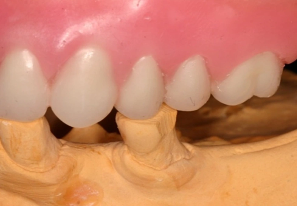 Assessment of the Restorative Space | Biologically Contoured Esthetic ...