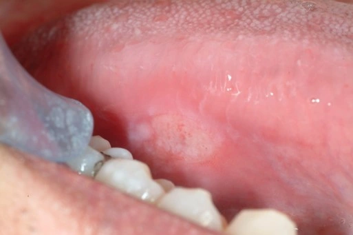 Clinical Appearance - Oral Cancer - Dentalcare