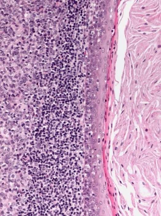 Diagnostic Information | Papule in the Right Floor of the Mouth ...