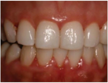 Gingivitis Treatment - Stannous Fluoride Toothpaste | Dentalcare