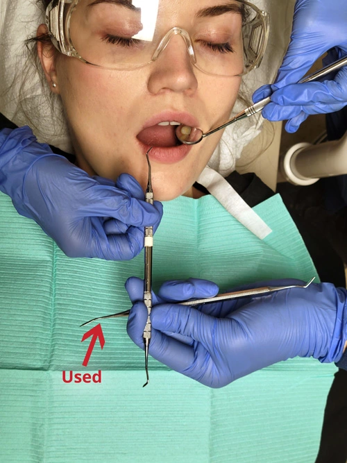 The Single-handed Transfer - The Concepts of Four-handed Dentistry ...