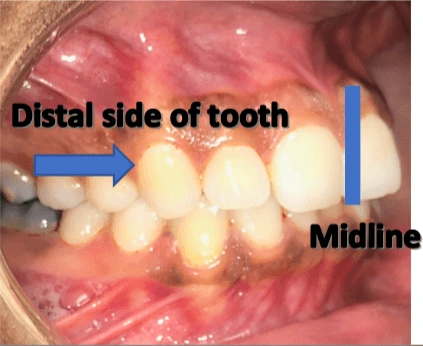 Terms D-L - Oral Health Care: A Whole New Language - Dentalcare