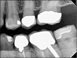 Maintenance of Amalgam Restorations - Care & Maintenance of Dental ...