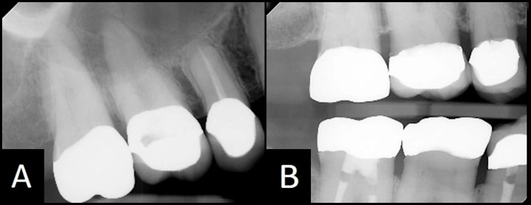 Problem #5: Comparison of periapical images versus bitewing images ...