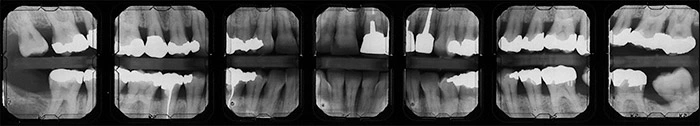 Bitewing Surveys - Intraoral Radiographic Anatomy - Dentalcare